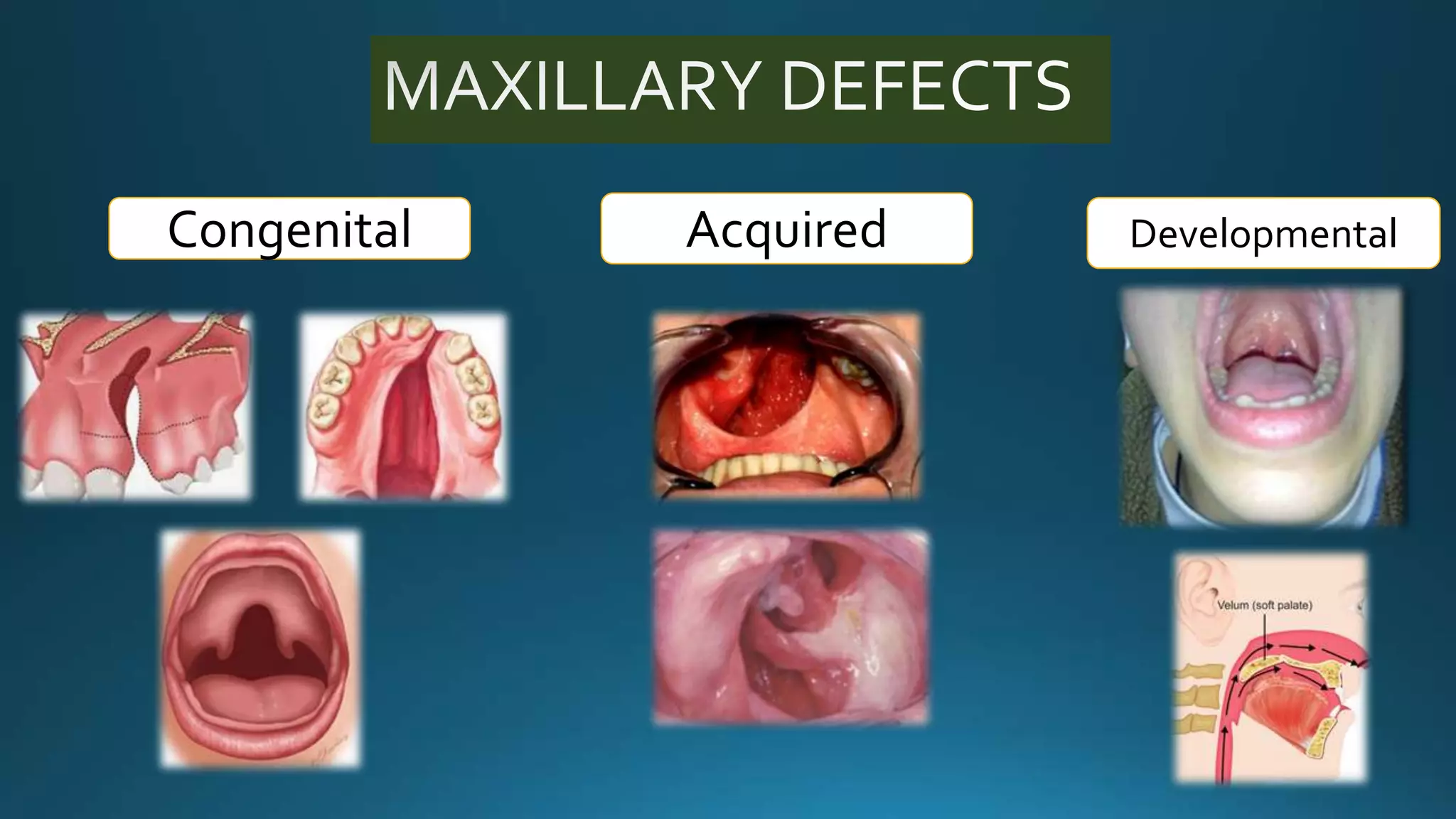 Obturator prosthesis for management of maxillary defects | PPTX