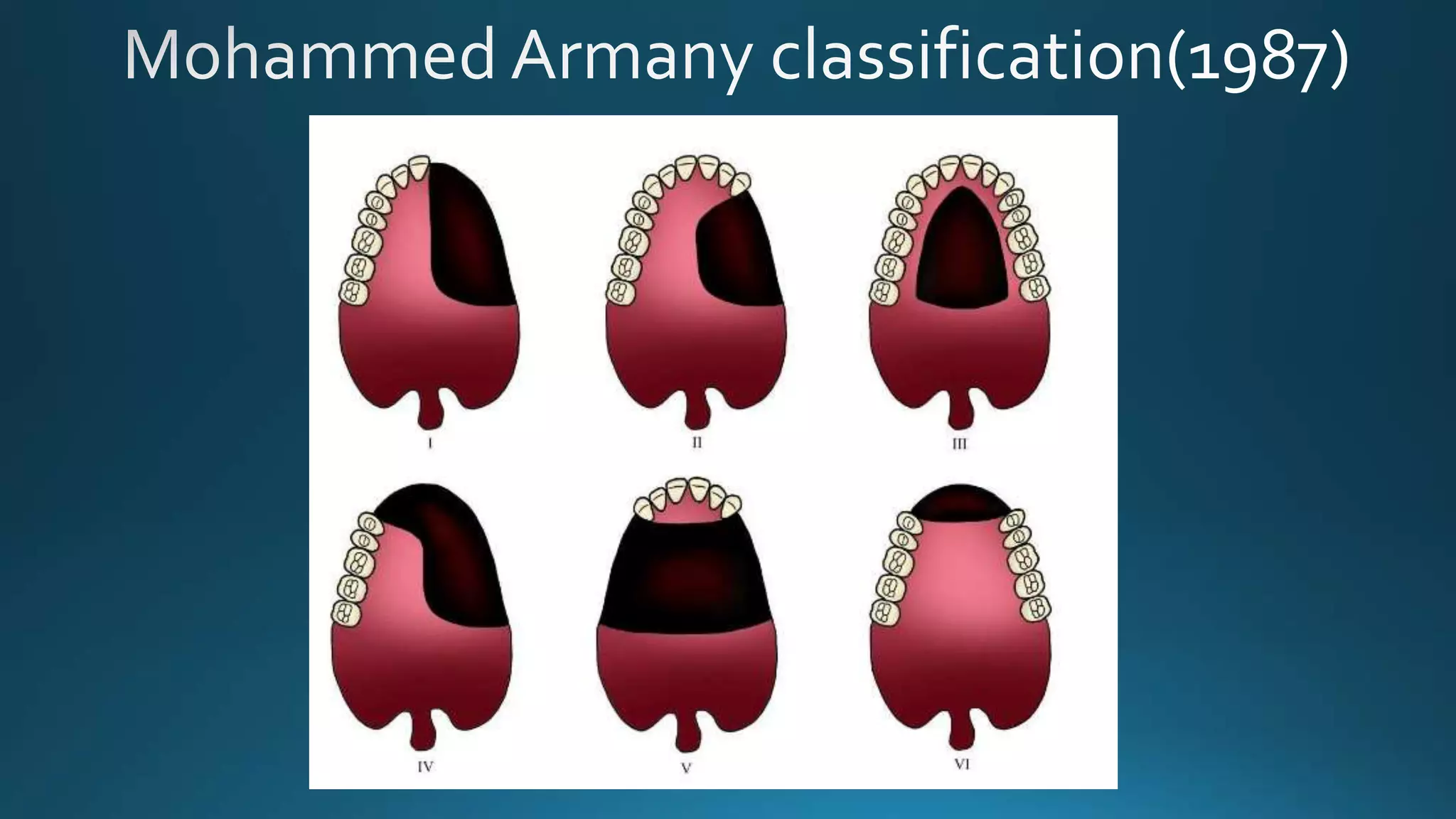 Obturator prosthesis for management of maxillary defects | PPTX