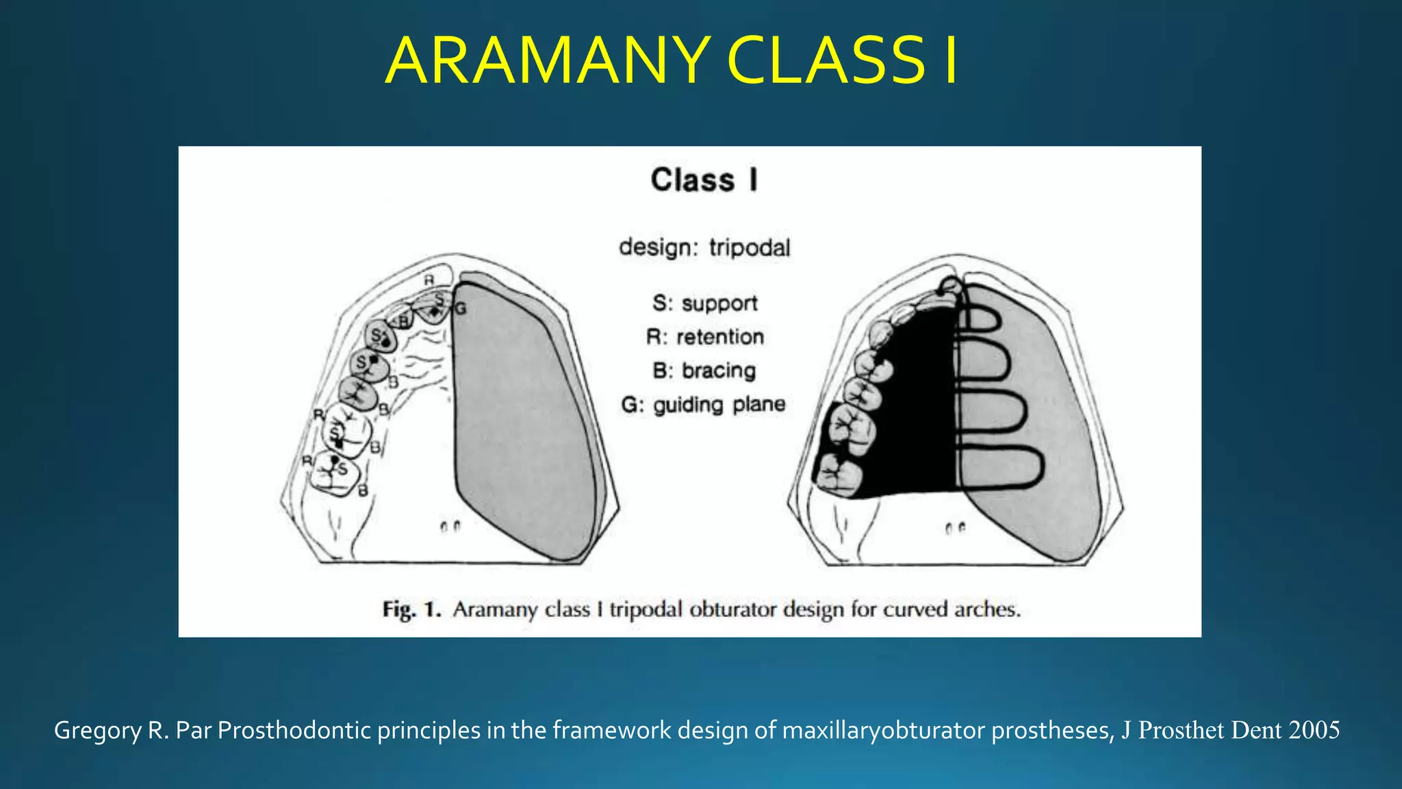 Obturator prosthesis for management of maxillary defects | PPTX