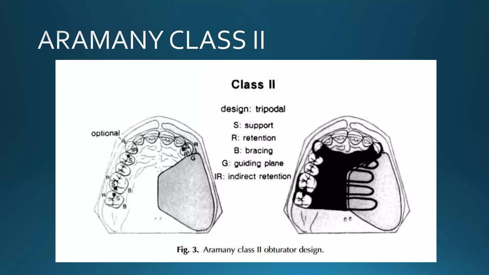 Obturator prosthesis for management of maxillary defects | PPTX