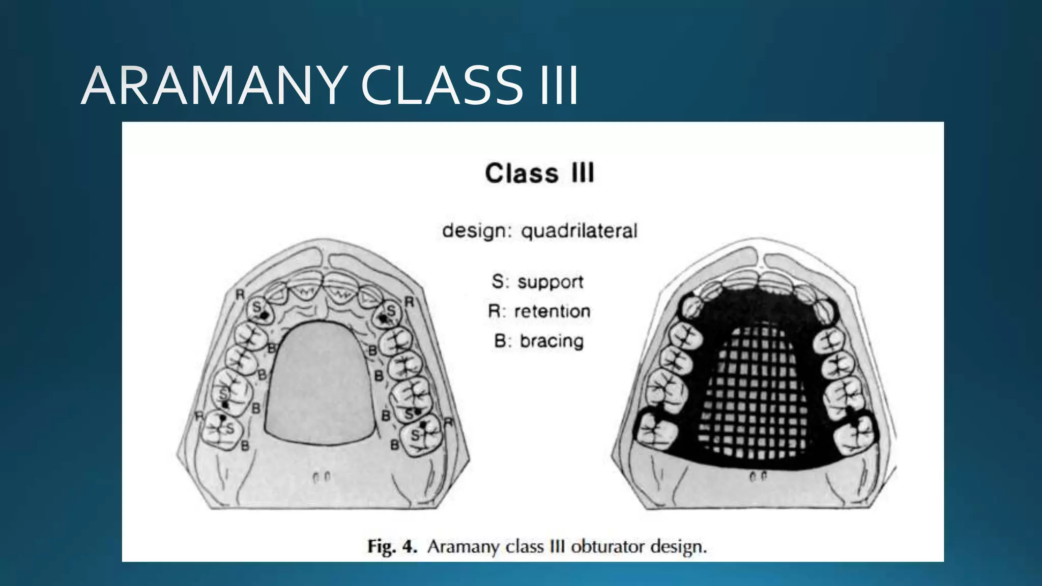 Obturator prosthesis for management of maxillary defects | PPTX