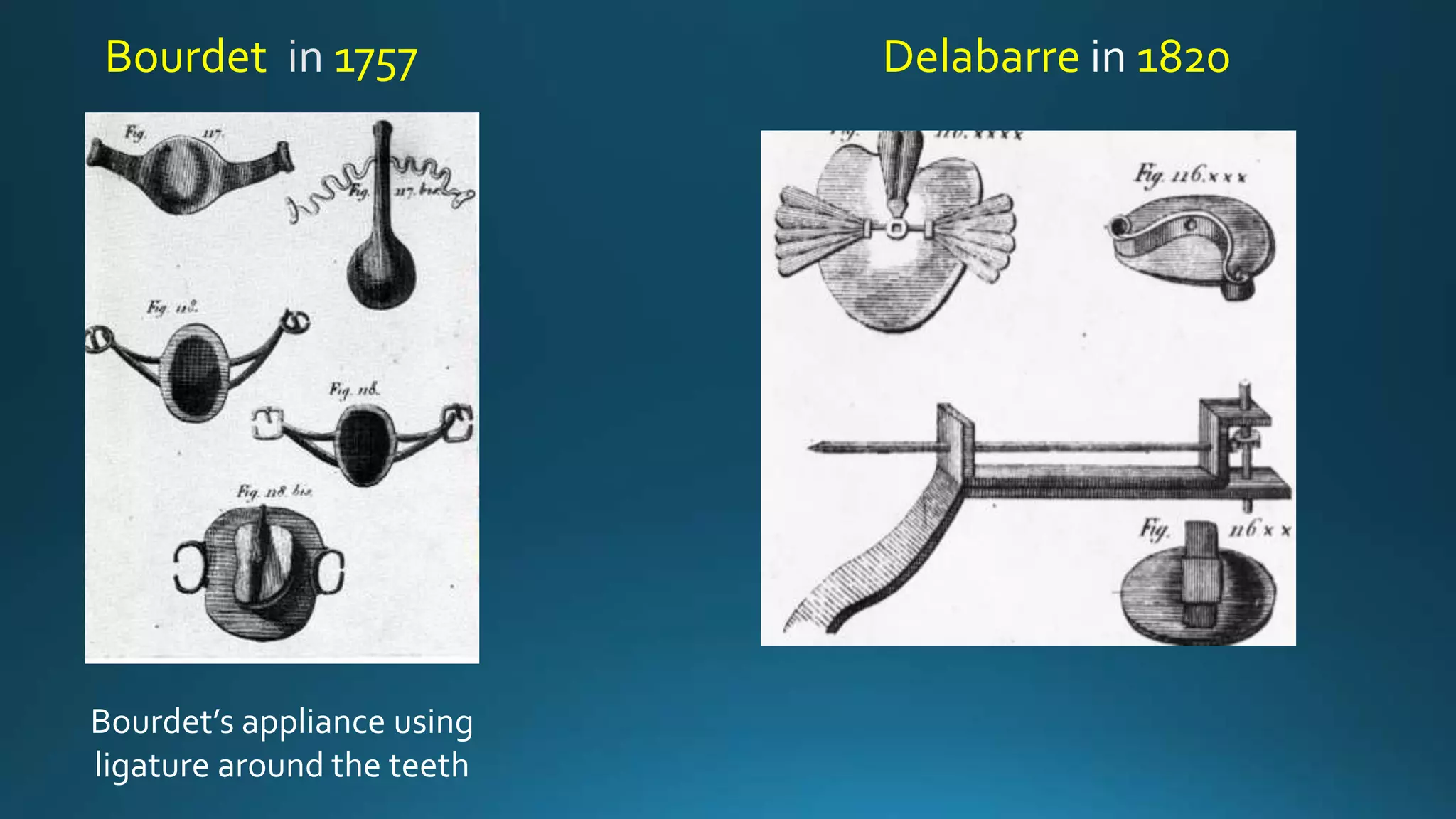 Obturator prosthesis for management of maxillary defects | PPTX