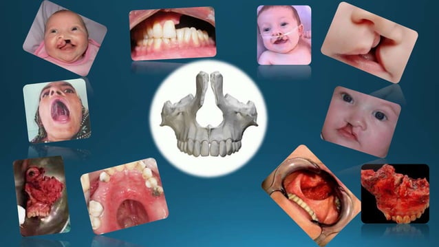 Obturator prosthesis for management of maxillary defects | PPTX