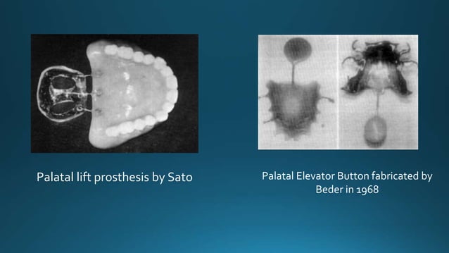 Obturator prosthesis for management of maxillary defects | PPTX