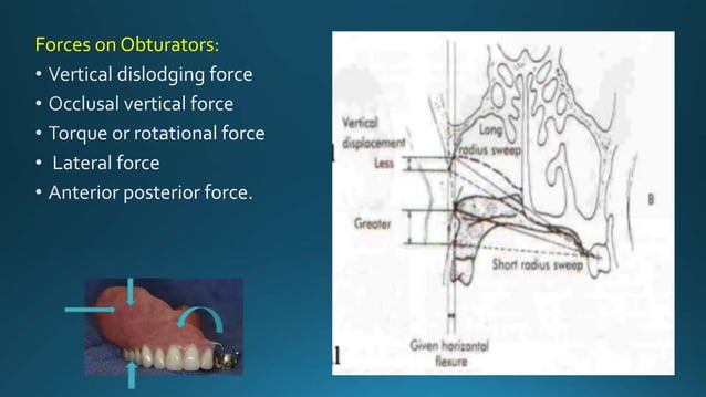 Obturator prosthesis for management of maxillary defects | PPTX