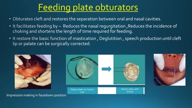 Obturator prosthesis for management of maxillary defects | PPTX