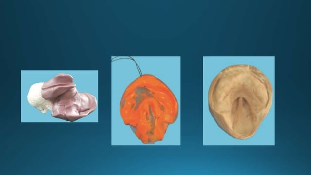 Obturator prosthesis for management of maxillary defects | PPTX