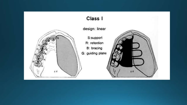 Obturator prosthesis for management of maxillary defects | PPTX