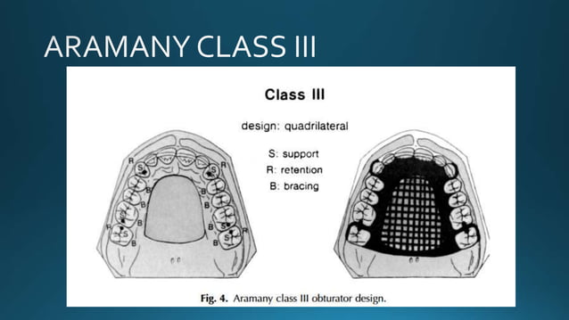 Obturator prosthesis for management of maxillary defects | PPTX