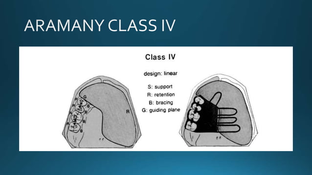 Obturator prosthesis for management of maxillary defects | PPTX