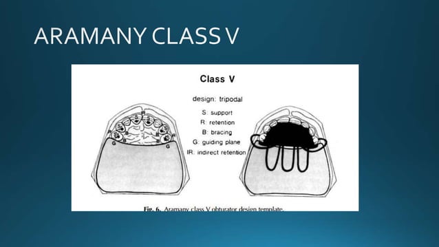 Obturator prosthesis for management of maxillary defects | PPTX