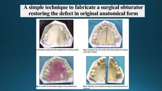 Obturator prosthesis for management of maxillary defects | PPTX