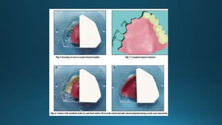 Obturator prosthesis for management of maxillary defects | PPTX