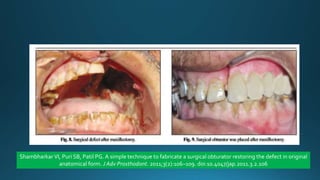 Obturator prosthesis for management of maxillary defects | PPTX