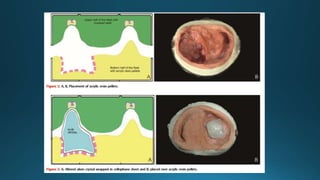 Obturator prosthesis for management of maxillary defects | PPTX