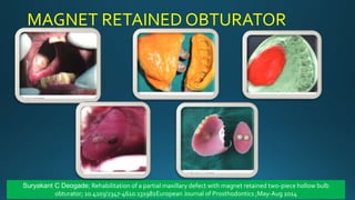 Obturator prosthesis for management of maxillary defects | PPTX