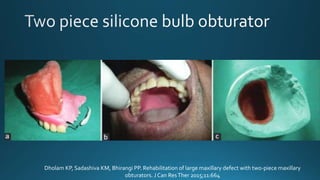 Obturator prosthesis for management of maxillary defects | PPTX