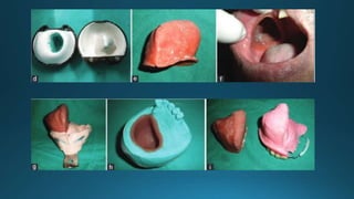 Obturator prosthesis for management of maxillary defects | PPTX