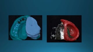 Obturator prosthesis for management of maxillary defects | PPTX