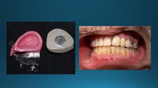 Obturator prosthesis for management of maxillary defects | PPTX