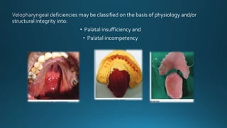 Obturator prosthesis for management of maxillary defects | PPTX