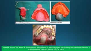 Obturator prosthesis for management of maxillary defects | PPTX
