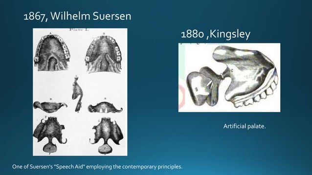 Obturator prosthesis for management of maxillary defects | PPTX