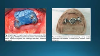 Obturator prosthesis for management of maxillary defects | PPTX