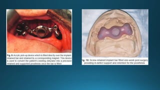 Obturator prosthesis for management of maxillary defects | PPTX