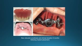 Obturator prosthesis for management of maxillary defects | PPTX