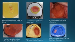 Obturator prosthesis for management of maxillary defects | PPTX