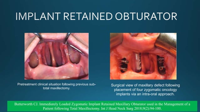 Obturator prosthesis for management of maxillary defects