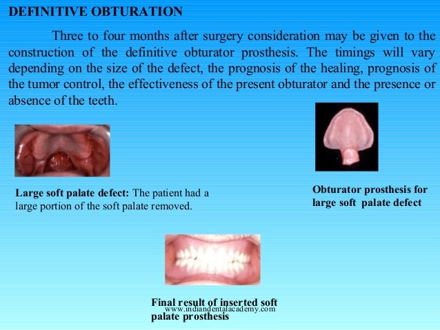 Obturator brijesh /certified fixed orthodontic courses by Indian den…