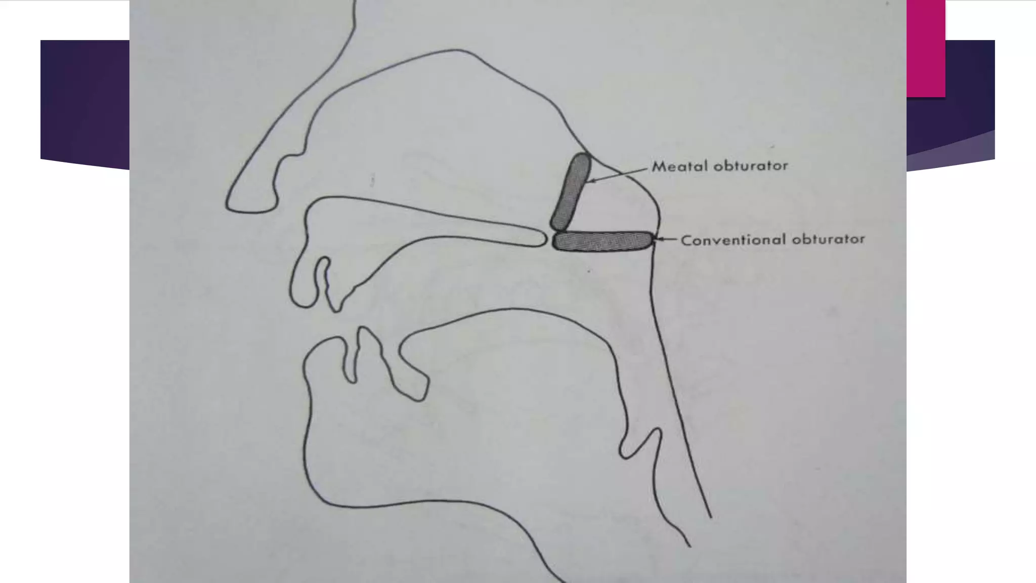 Obturator ppt | PPTX