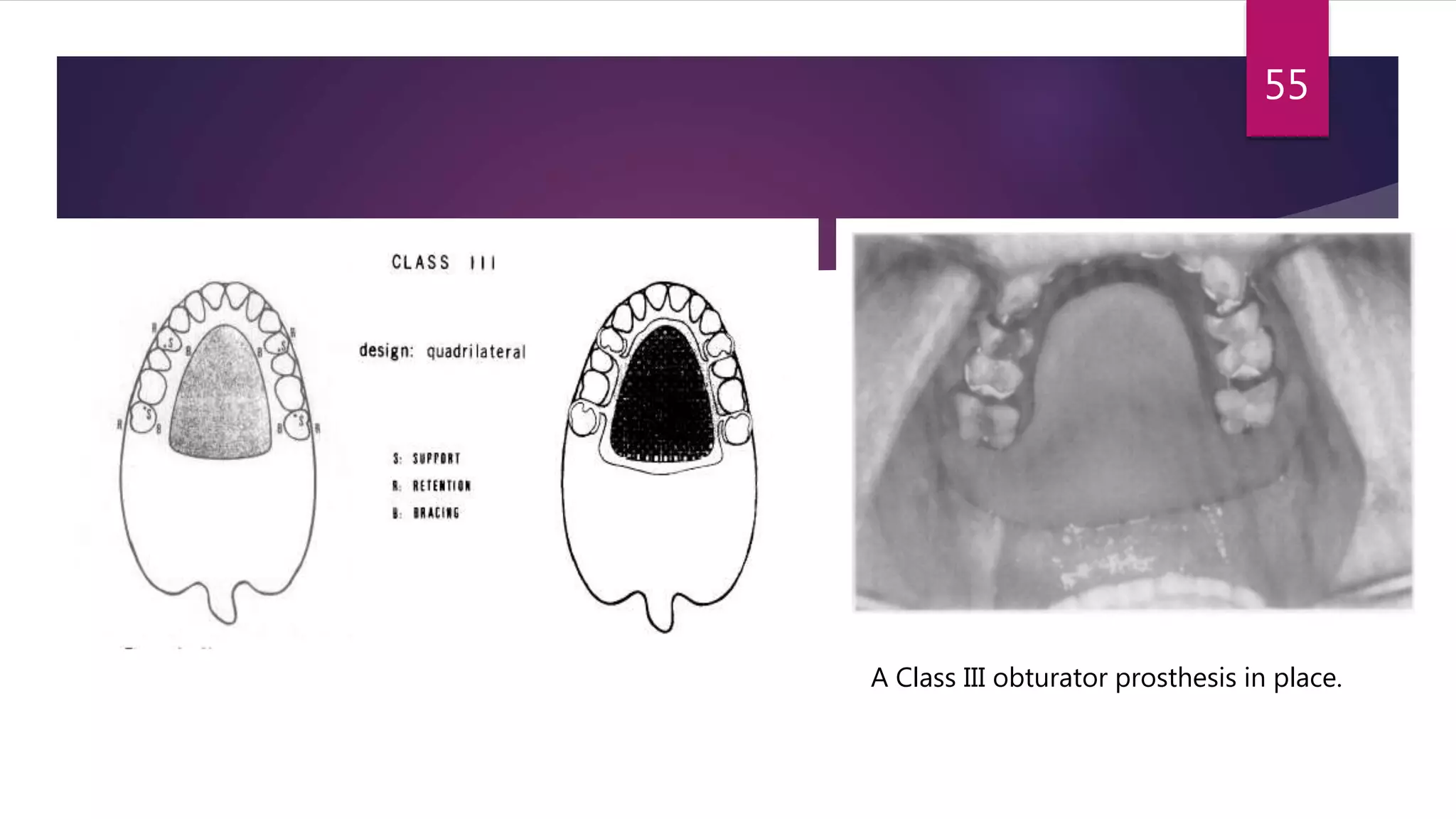 Obturator ppt | PPTX