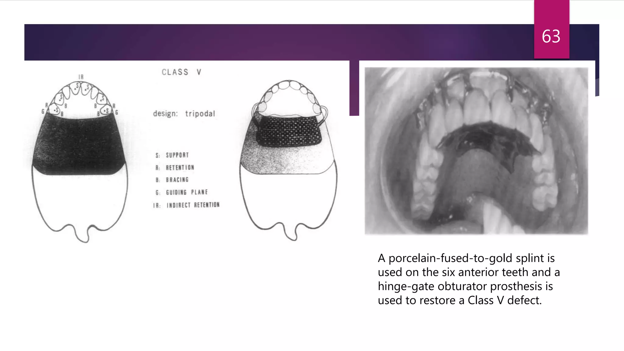 Obturator ppt | PPTX