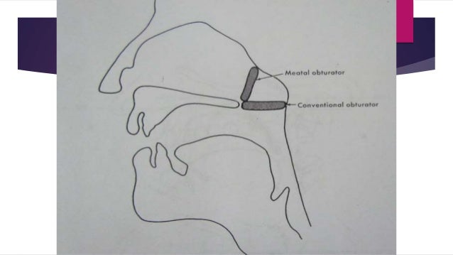 Obturator ppt