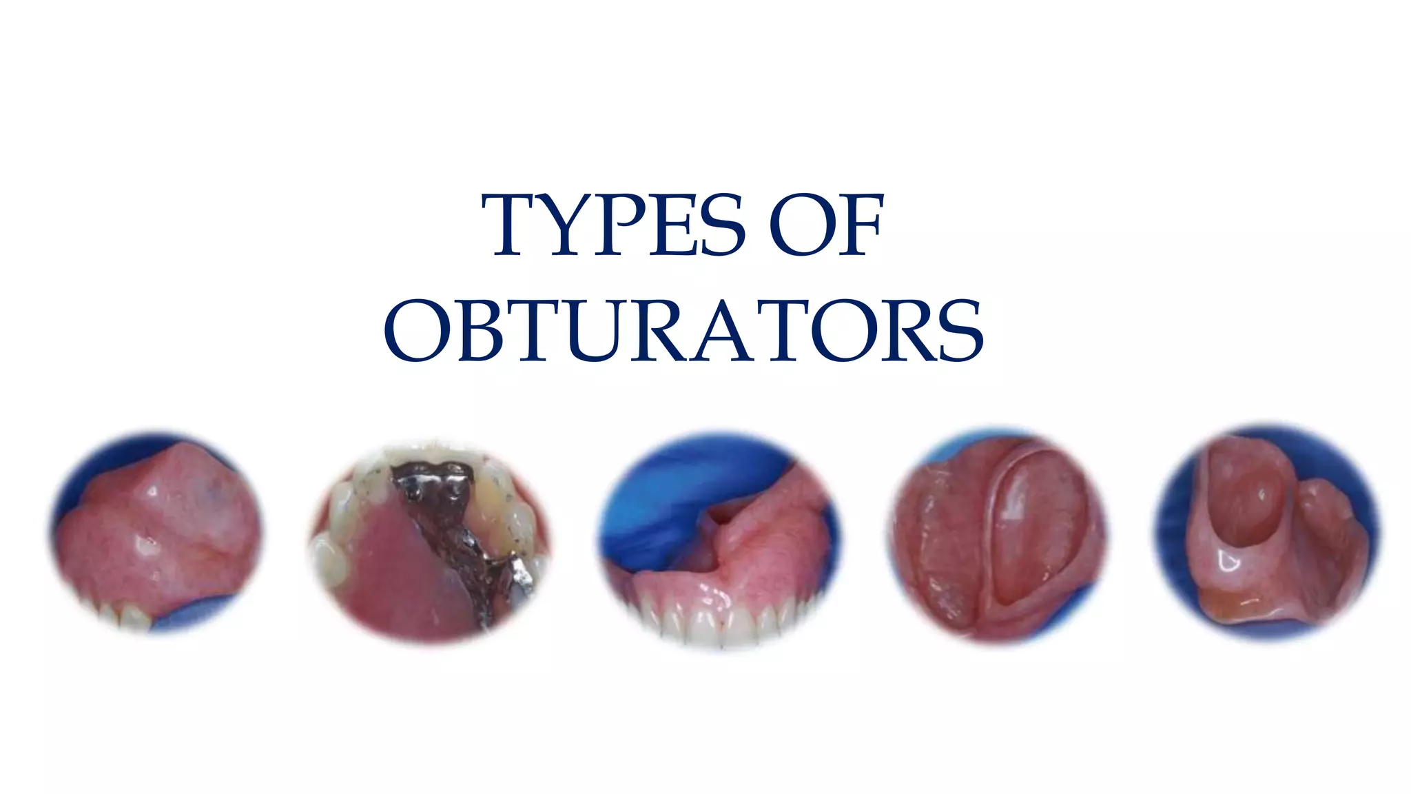 Obturators | PPTX | Dental Health | Diseases and Conditions