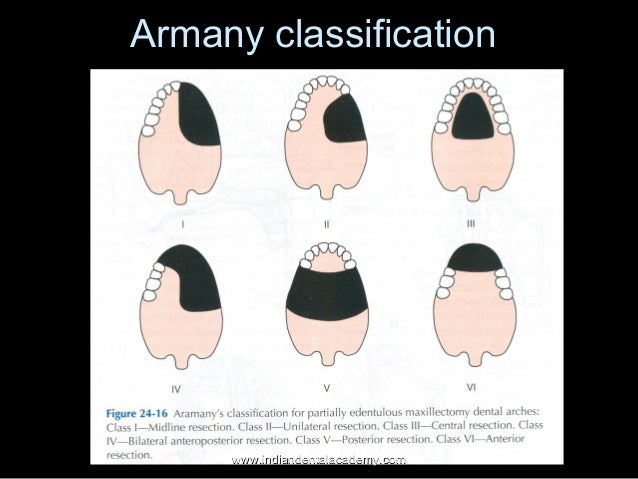 Obturators/ orthodontic seminars