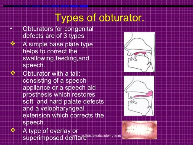 Obturator seminar final /orthodontic courses by Indian dental academy