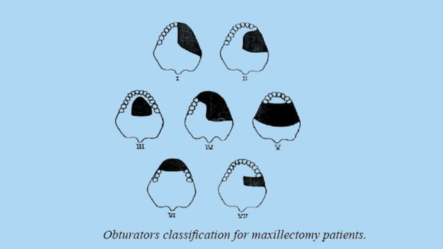 Brief discussion for Obturators used in Maxillofacial Rehabilitation ...