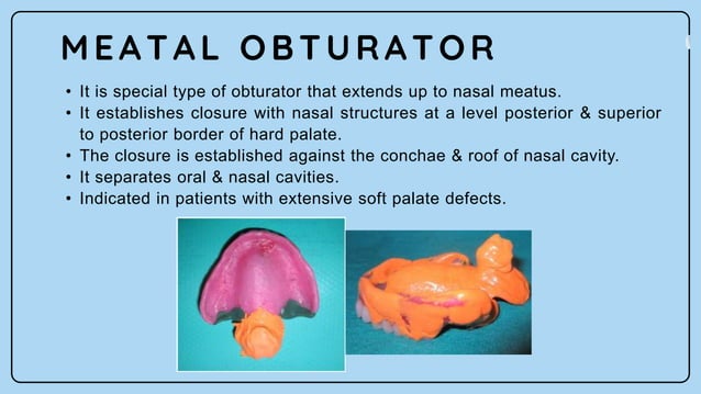 Brief discussion for Obturators used in Maxillofacial Rehabilitation ...