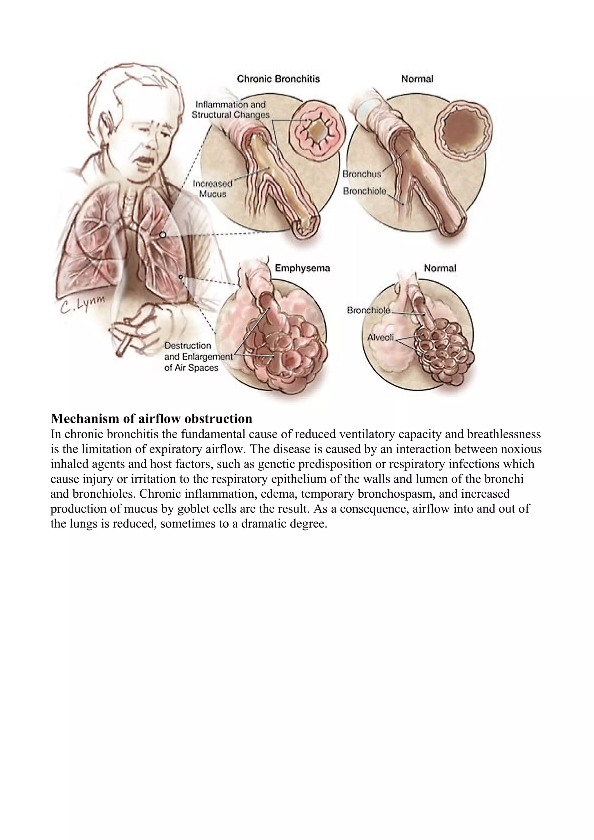 Chronic bronchitis | DOC