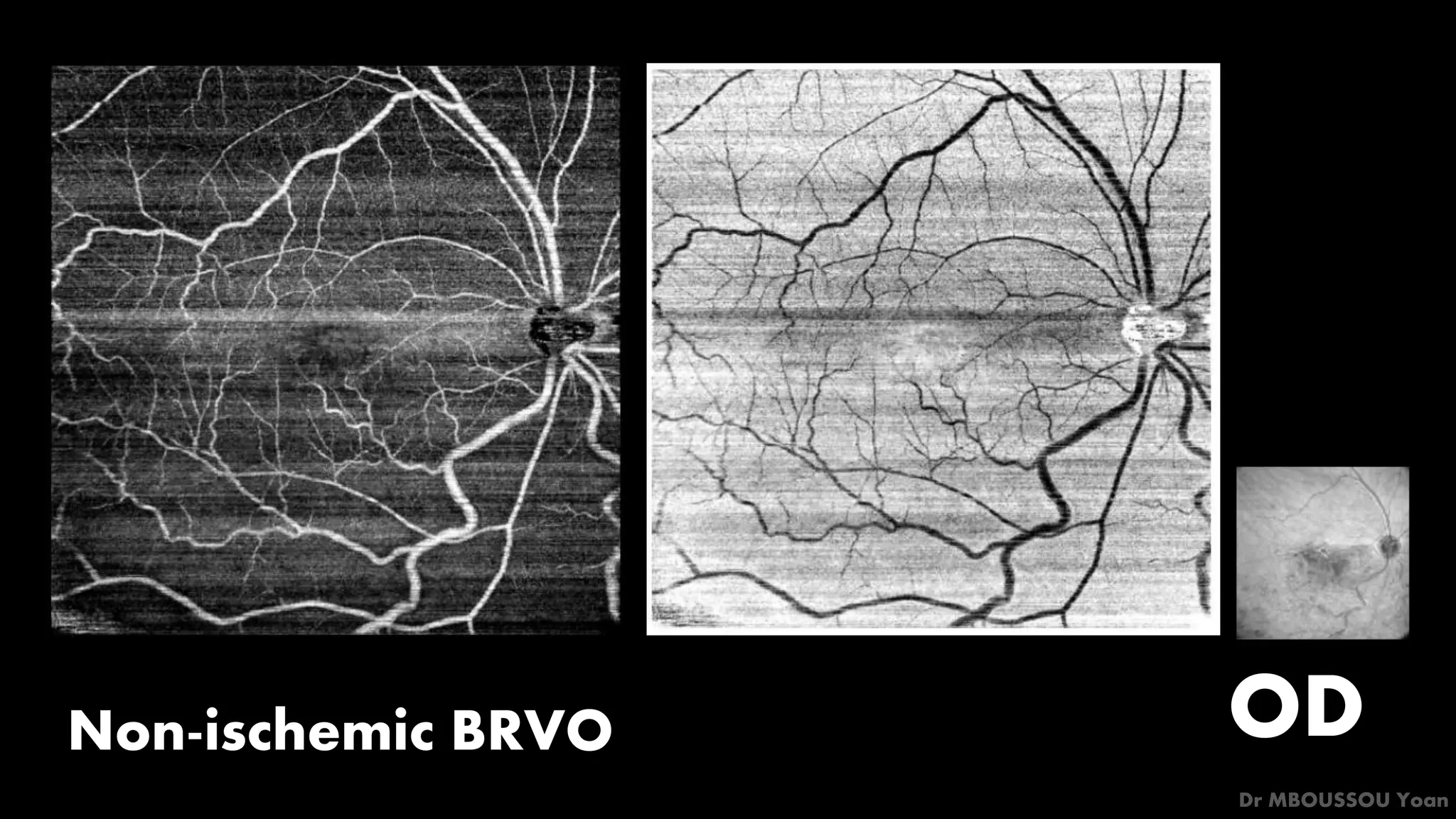 OCT of branch retinal vein occlusion. Clinical case | PPT
