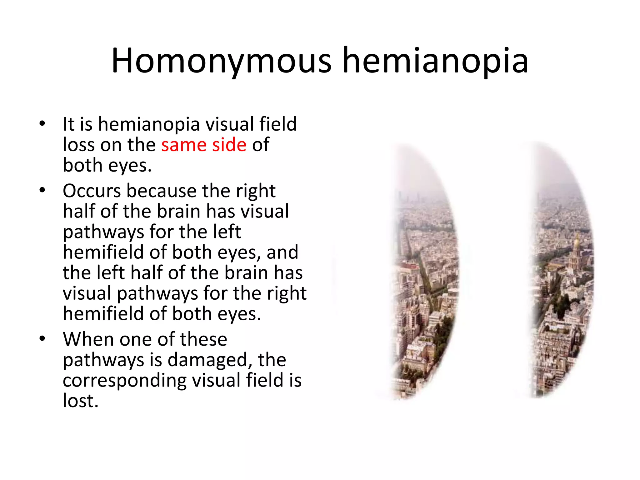 Occipital lobe 2 syndromes nwnw ppt | PPTX