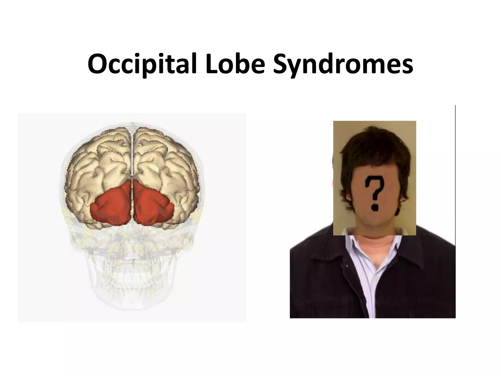 Occipital lobe 2 syndromes nwnw ppt | PPTX