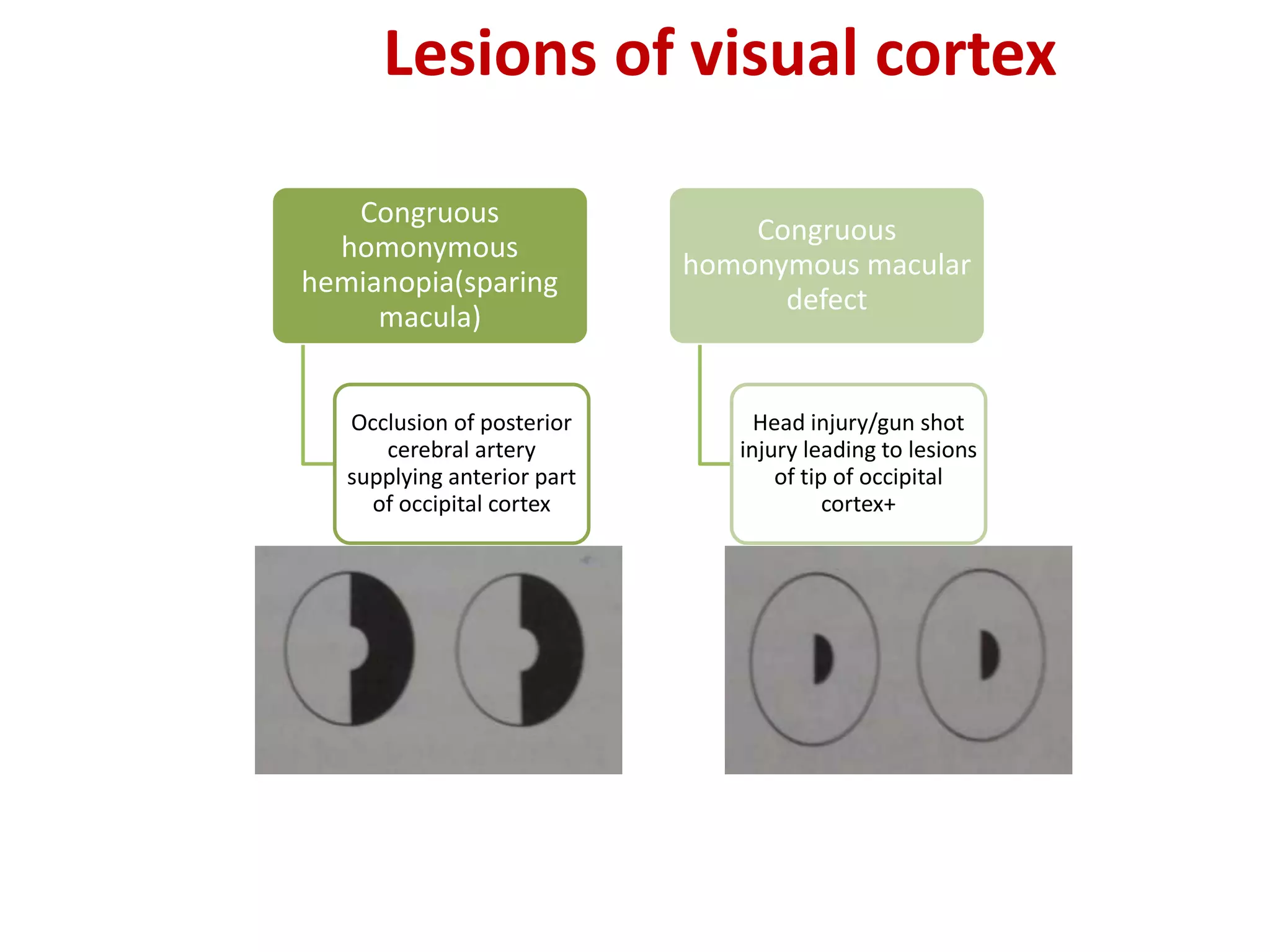 Occipital lobe 2 syndromes nwnw ppt | PPTX