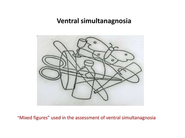 Occipital lobe 2 syndromes nwnw ppt | PPTX | Eye and Vision Conditions ...