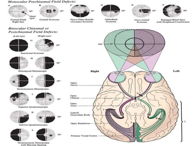 Occipital lobe 2 syndromes nwnw ppt