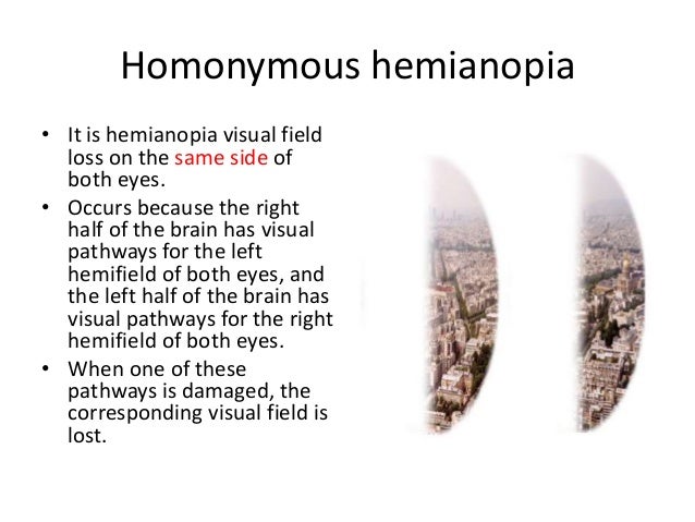 Occipital lobe 2 syndromes nwnw ppt